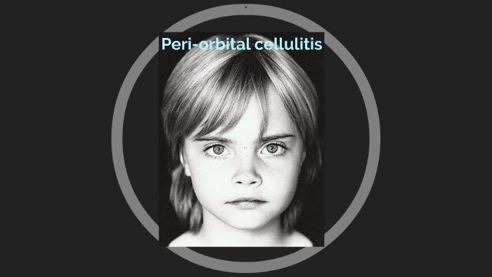 Peri-orbital cellulitis by Dorothy Chong on Prezi