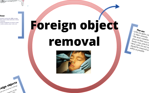 Removal of foreign objects in children. by Rochelle Zangen