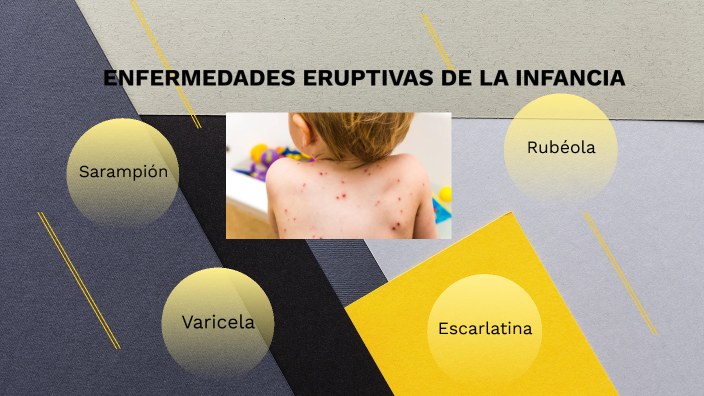 ENFERMEDADES ERUPTIVAS DE LA INFANCIA by Karlita Palomeque on Prezi