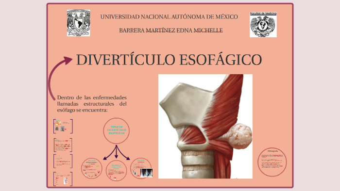 DIVERTÍCULO ESOFÁGICO by Michelle Brrz on Prezi