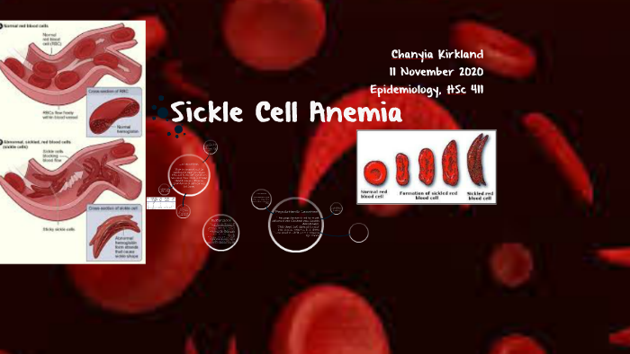 Sickle Cell Anemia by Chanyia Kirkland on Prezi