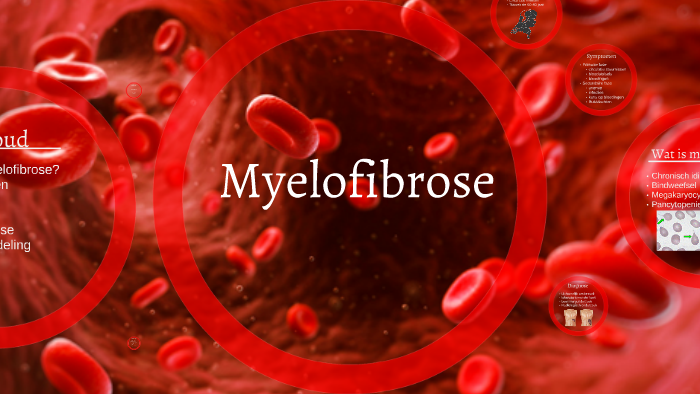Myelofibrose by Thomas Lockhorn on Prezi