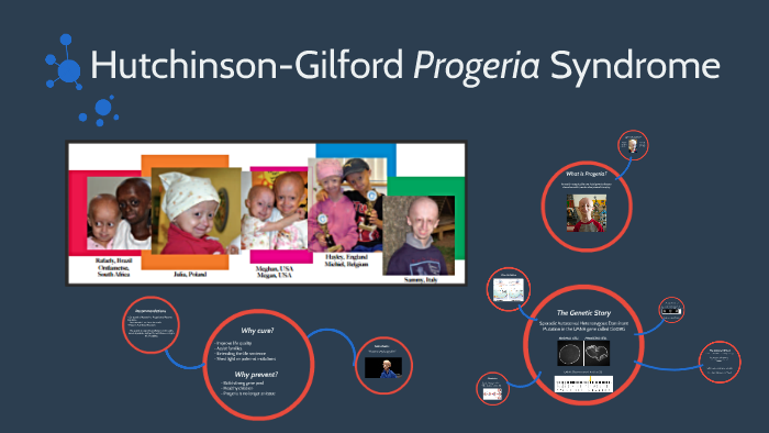 Hutchinson-Gilford Progeria Syndrome by Paige Emmett