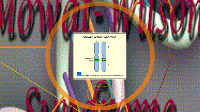 Mowat-Wilson Syndrome by Kayla McCall on Prezi