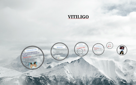 VITILIGO by morgan zender on Prezi