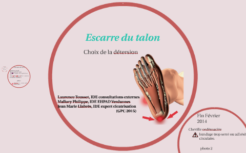 Escarre du talon:choix de la détersion by Laurence Tousset on Prezi