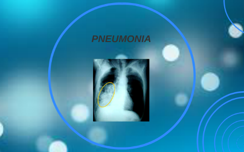PNEUMONIA by Salim Rizk on Prezi