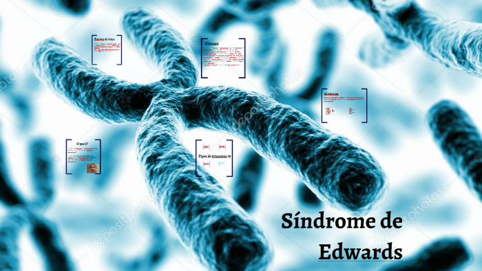 Síndrome de Edwards by Marta Fontes on Prezi