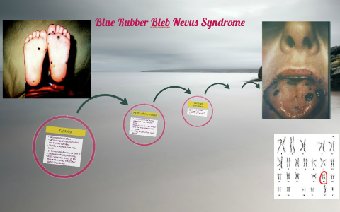 Blue Rubber Bleb Nevus Syndrome by Logan Evans on Prezi