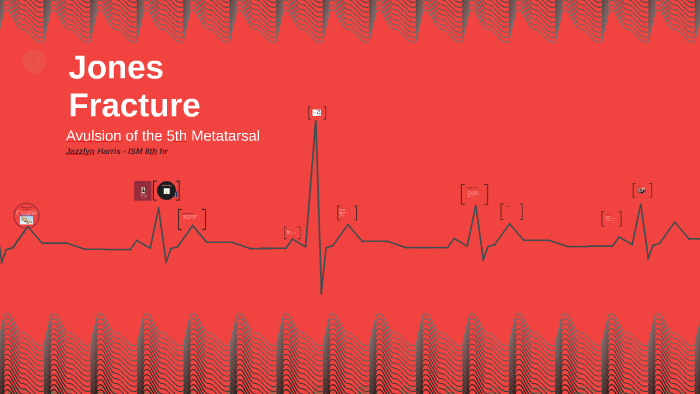 Jones Fracture by Jazzlyn Harris on Prezi