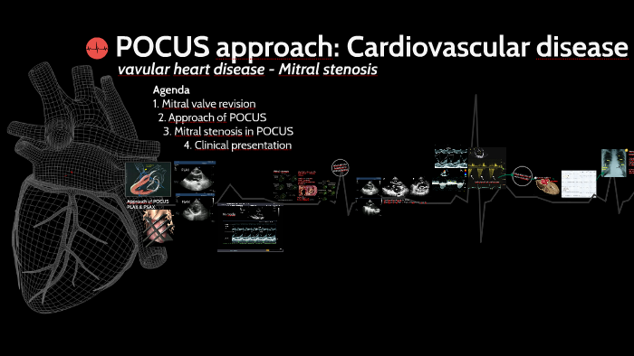 POCUS approach-CVD Mitral stenosis by CHAN COLA