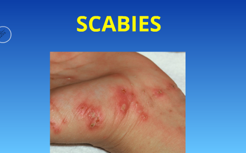 Scabies/ Human Anatomy by dalton drake on Prezi