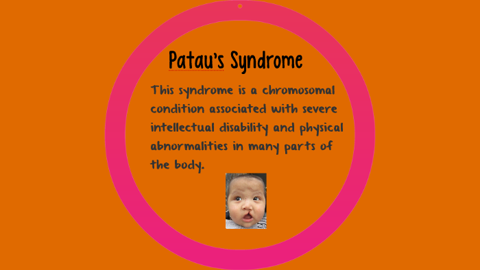 Patau's Syndrome by Maddie Tarsi on Prezi