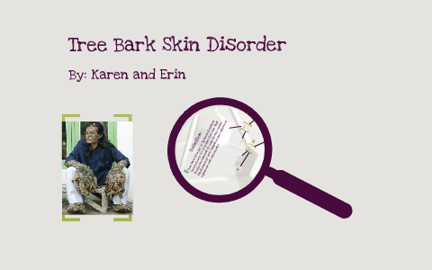 Tree bark skin disorder by Karen Escobedo on Prezi