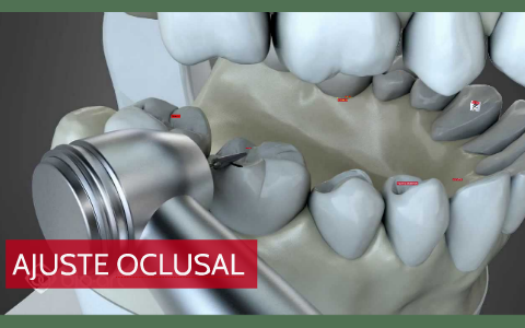 AJUSTE OCLUSAL by rosario castillo contreras on Prezi
