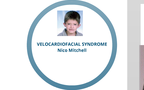 VeloCardioFacial Syndrome by Nico Mitchell on Prezi