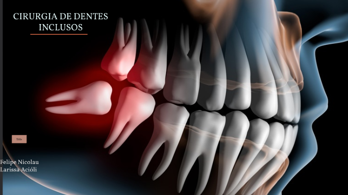 CIRURGIA DE DENTES INCLUSOS by Larissa Acioli on Prezi
