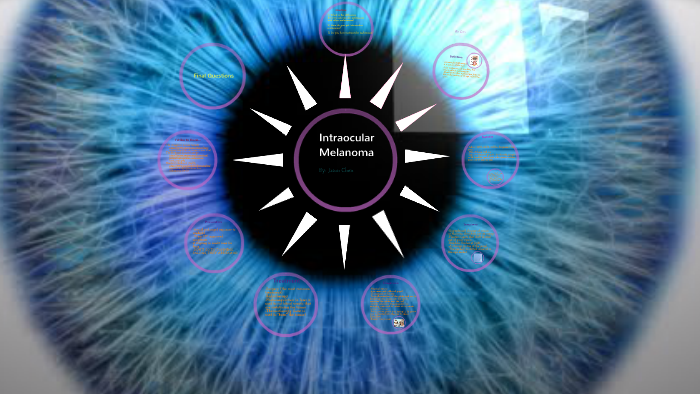 Intraocular Cancer by Ping-Chen Chen on Prezi