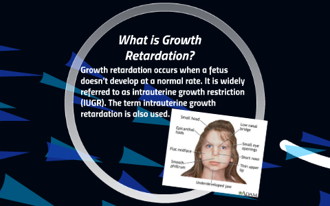 Growth Retardation by Timmy Carpenter-Frank on Prezi