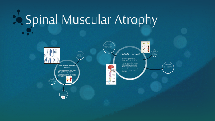 Spinal Muscular Atrophy by Damien Lynch on Prezi