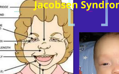 Jacobsen Syndrome by Priscilla Ryder on Prezi