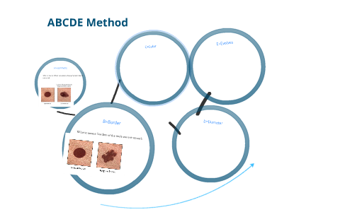 ABCDE Method: Malignant Melanoma Prevention by Ariel Ponce on Prezi