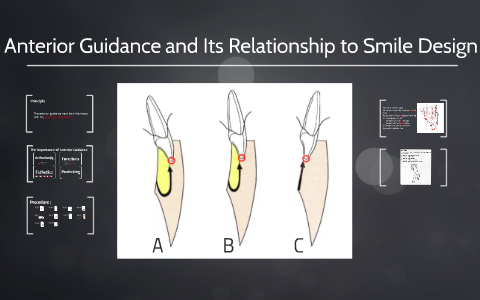 Anterior Guidance and Its Relationship to Smile Design by timo trista ...