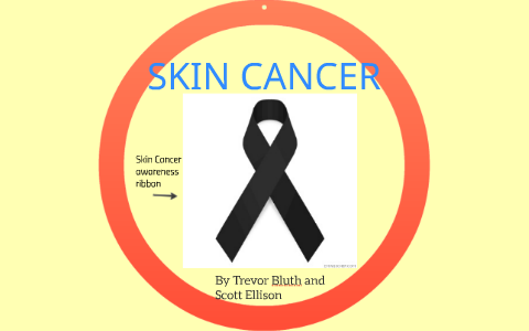SKIN CANCER by Trevor bluth on Prezi