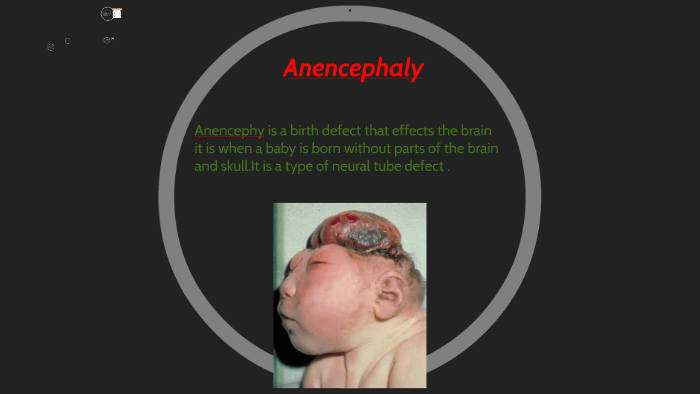 Hydrocephalus and Anencephaly by jose barrios on Prezi