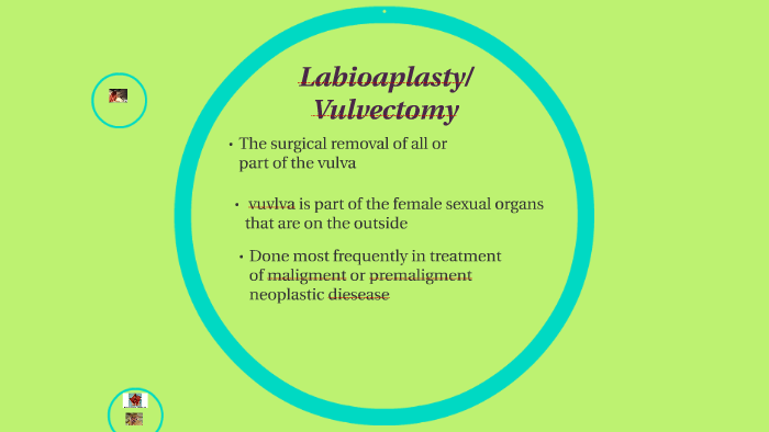 Labioplasty/ Vuvlectomy by Derrick Samuel on Prezi
