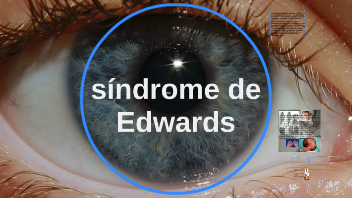 syndrome de Edwards by carolina velez on Prezi