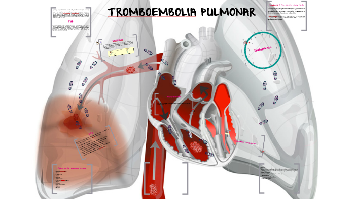 TROMBOEMBOLIA PULMONAR by Miryam Garcia on Prezi