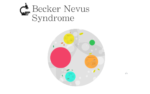 Becker Nevus Syndrome by Renelle McFarlane on Prezi