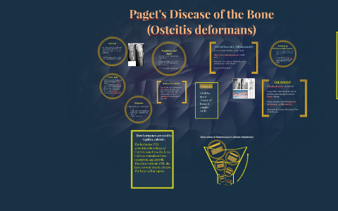 Paget's Disease (Osteitis deformans) by Jess Miller on Prezi