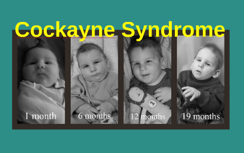 Cockayne Syndrome by Rebecca Alberts on Prezi