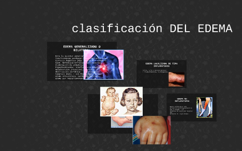 clasificación DEL EDEMA by loren guzman on Prezi