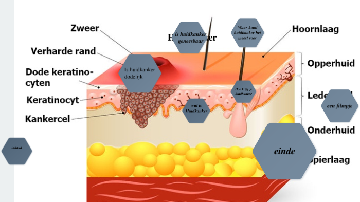 Huidkanker by Jan Peter on Prezi