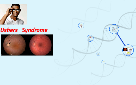 Ushers Syndrome by Justin Atkins on Prezi