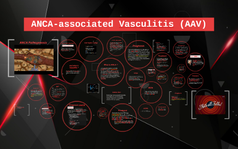 ANCA-Positive Vasculitis by Maxi Hamed on Prezi