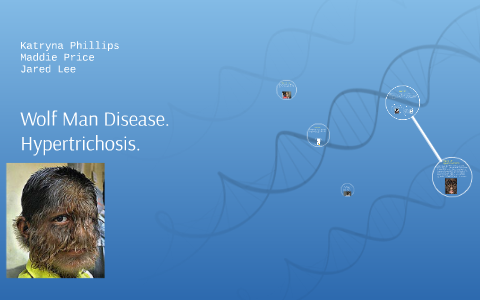 Wolf Man Disease. by jared lee on Prezi