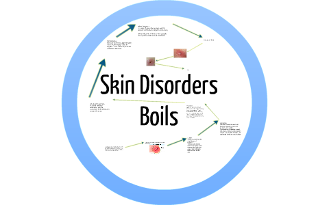 Anatomy- Skin Disorders: Boils by Brian Green on Prezi