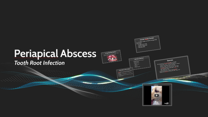 Periapical Abscess by victoria velasco on Prezi