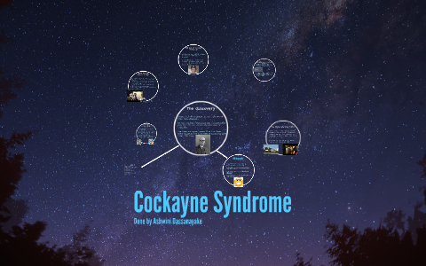 Cockayne Syndrome by Ashwini Dassanayake