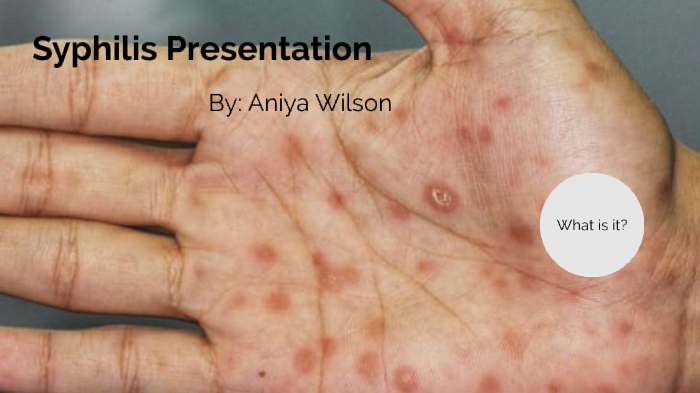 Syphilis Presentation by Aniya Wilson on Prezi
