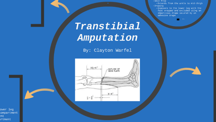Transtibial Amputation by Clay Warfel on Prezi