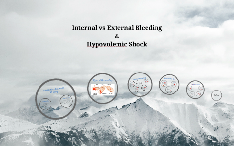 Internal vs External Bleeding by Krupa Shah on Prezi