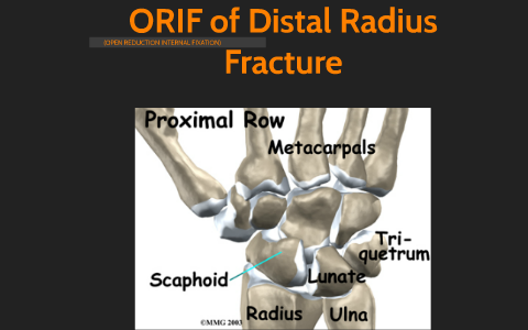 ORIF of Distal Radius by Irving Garfio on Prezi