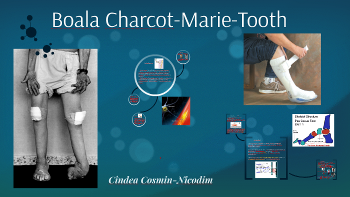 Boala Charcot-Marie-Tooth by Cosmin Cindea on Prezi