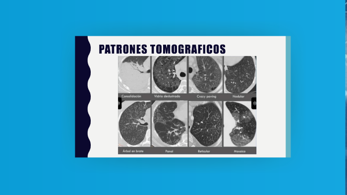 TAC TORAX NORMAL Y PATOLOGICO by Angee Lys Rosado on Prezi