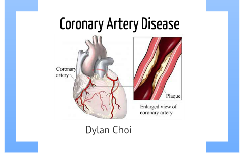 Coronary Artery Disease by Dylan Choi on Prezi